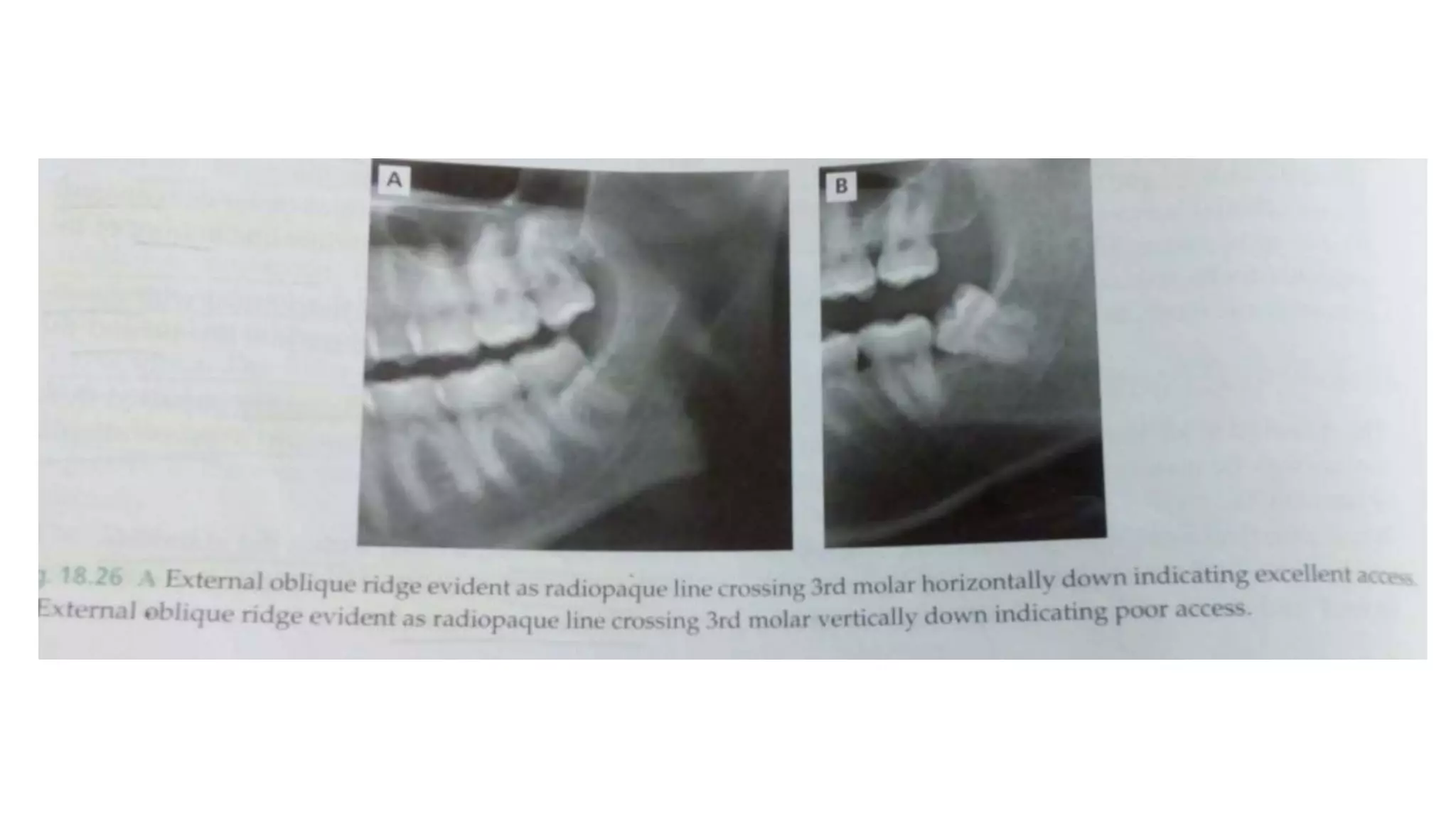Radiographic assessment of impacted teeth | PPTX