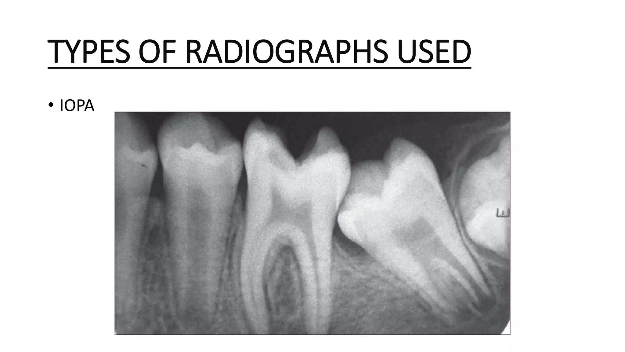 Radiographic assessment of impacted teeth | PPTX