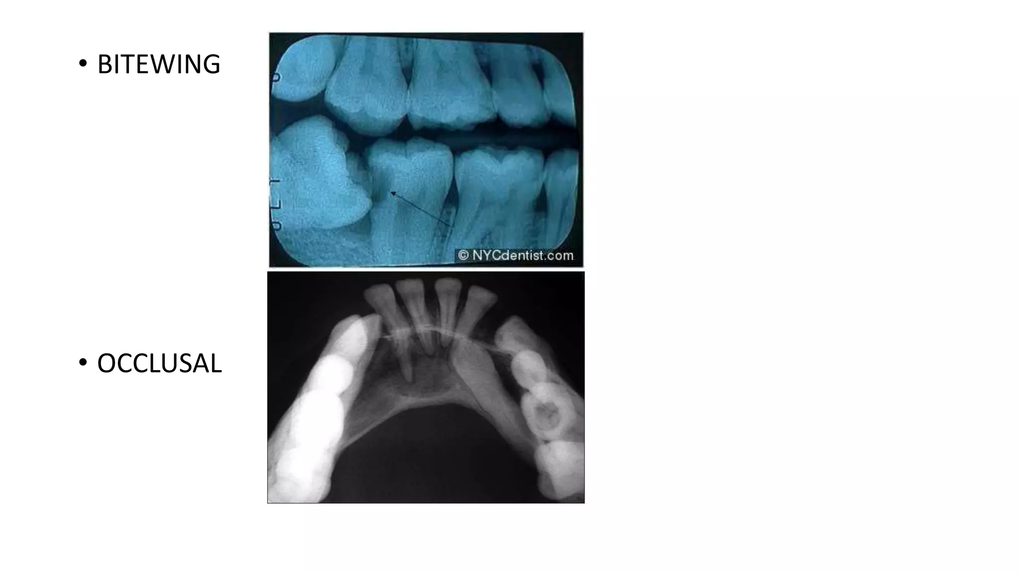 Radiographic assessment of impacted teeth | PPTX