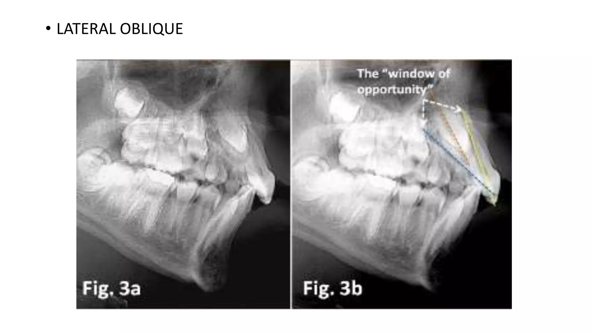 Radiographic assessment of impacted teeth | PPTX