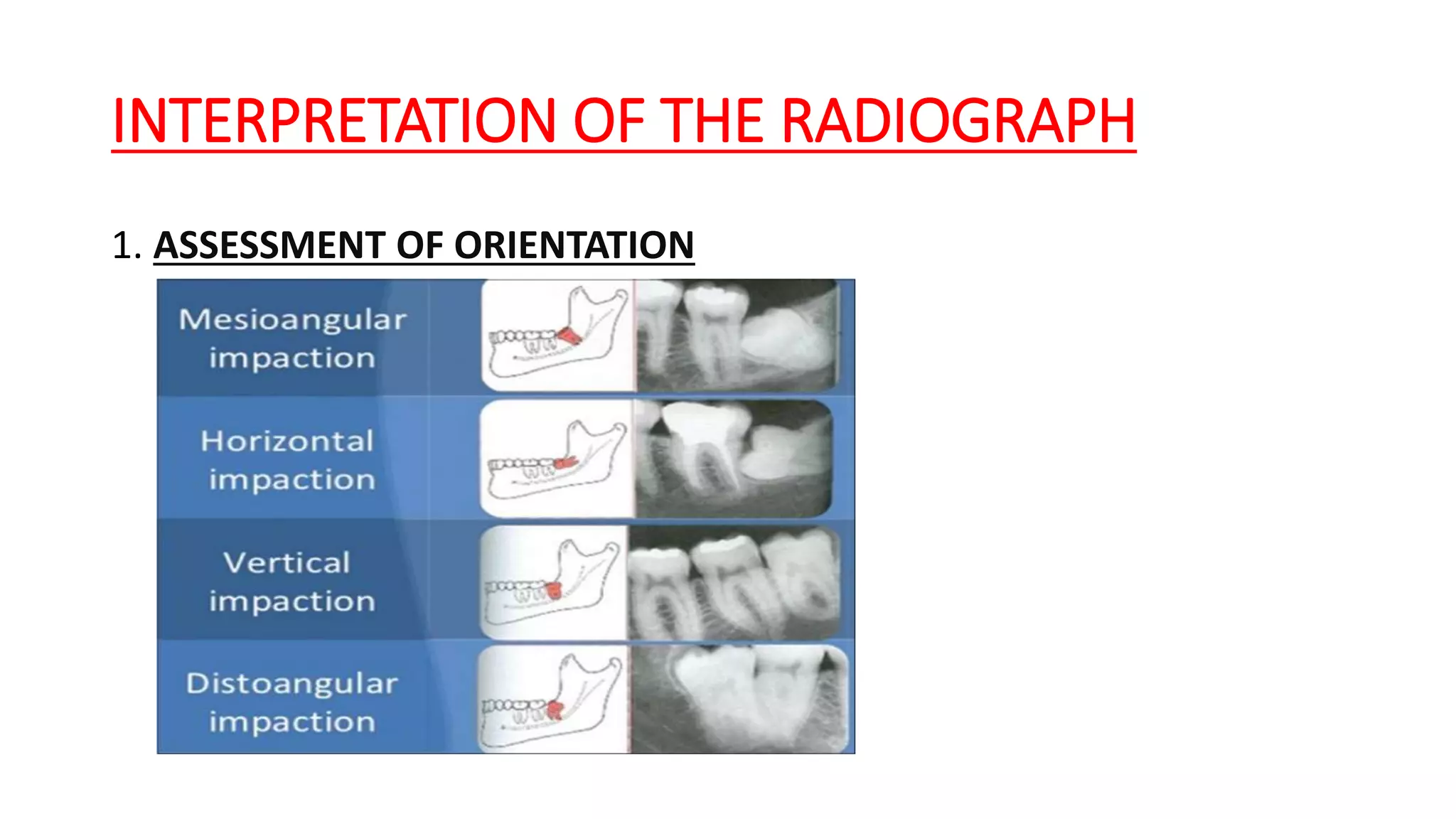 Radiographic assessment of impacted teeth | PPTX