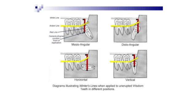 Radiographic assessment of impacted teeth | PPTX