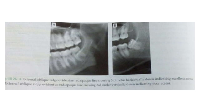 Radiographic assessment of impacted teeth | PPTX