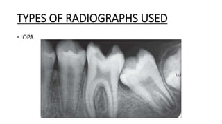 Radiographic assessment of impacted teeth | PPTX