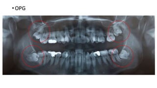 Radiographic assessment of impacted teeth | PPTX