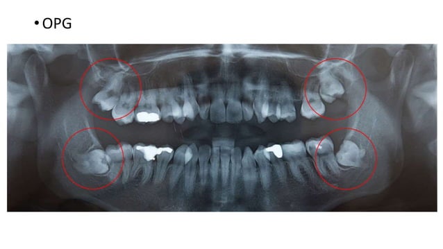 Radiographic assessment of impacted teeth | PPTX