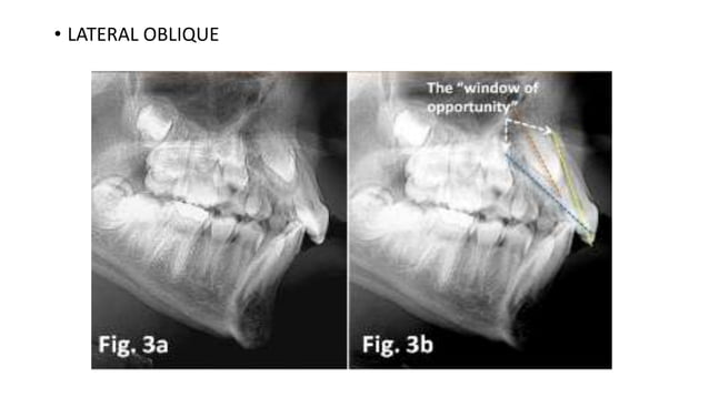 Radiographic assessment of impacted teeth | PPTX