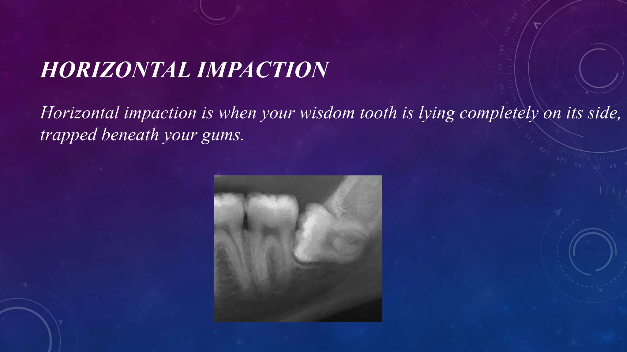 Radiographic assessment of impacted teeth.pptx