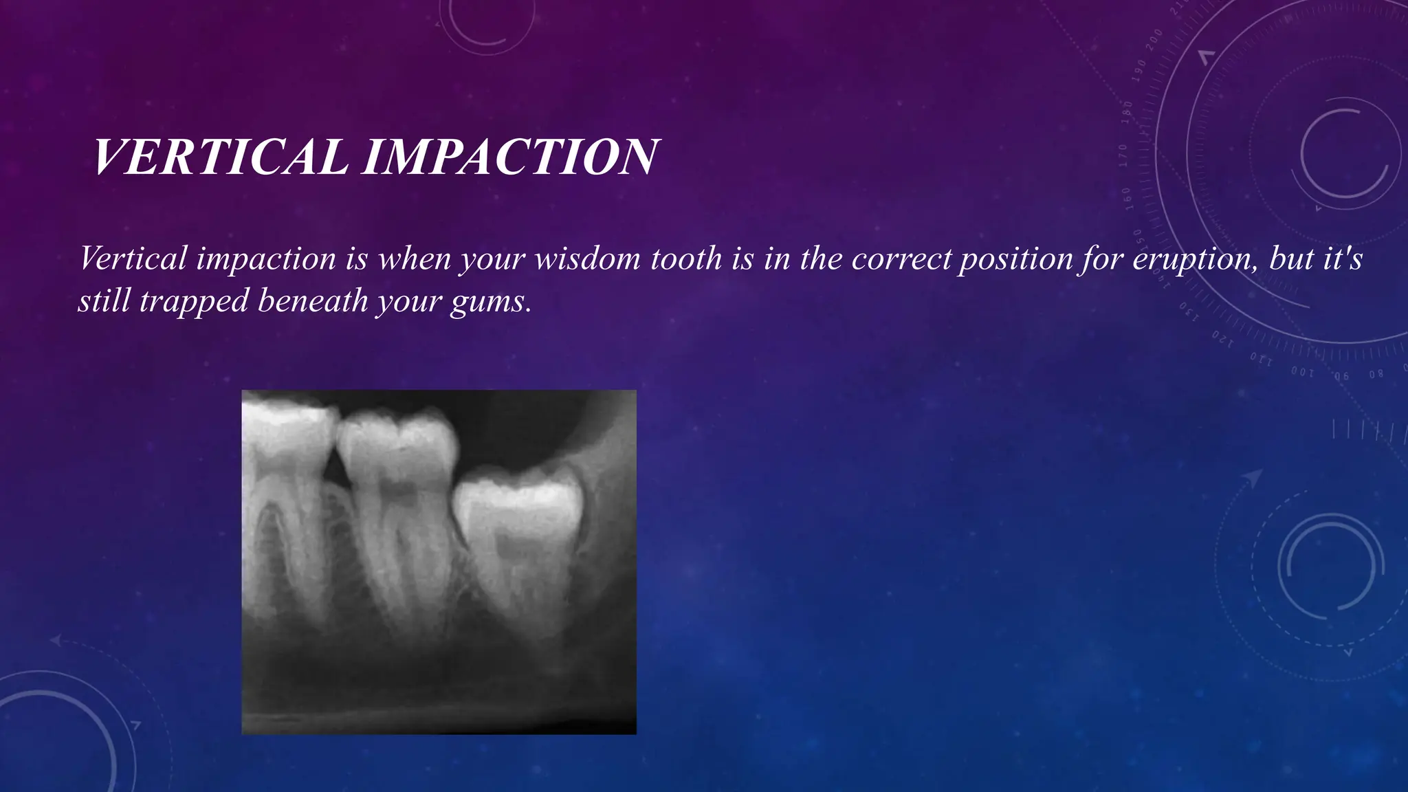 Radiographic assessment of impacted teeth.pptx