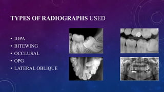 Radiographic assessment of impacted teeth.pptx