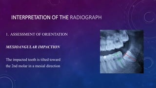 Radiographic assessment of impacted teeth.pptx