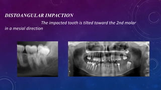 Radiographic assessment of impacted teeth.pptx