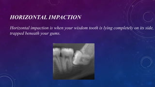 Radiographic assessment of impacted teeth.pptx