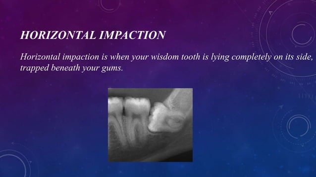 Radiographic assessment of impacted teeth.pptx | Dental Health ...