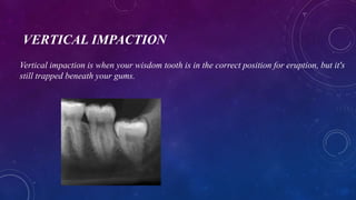 Radiographic assessment of impacted teeth.pptx