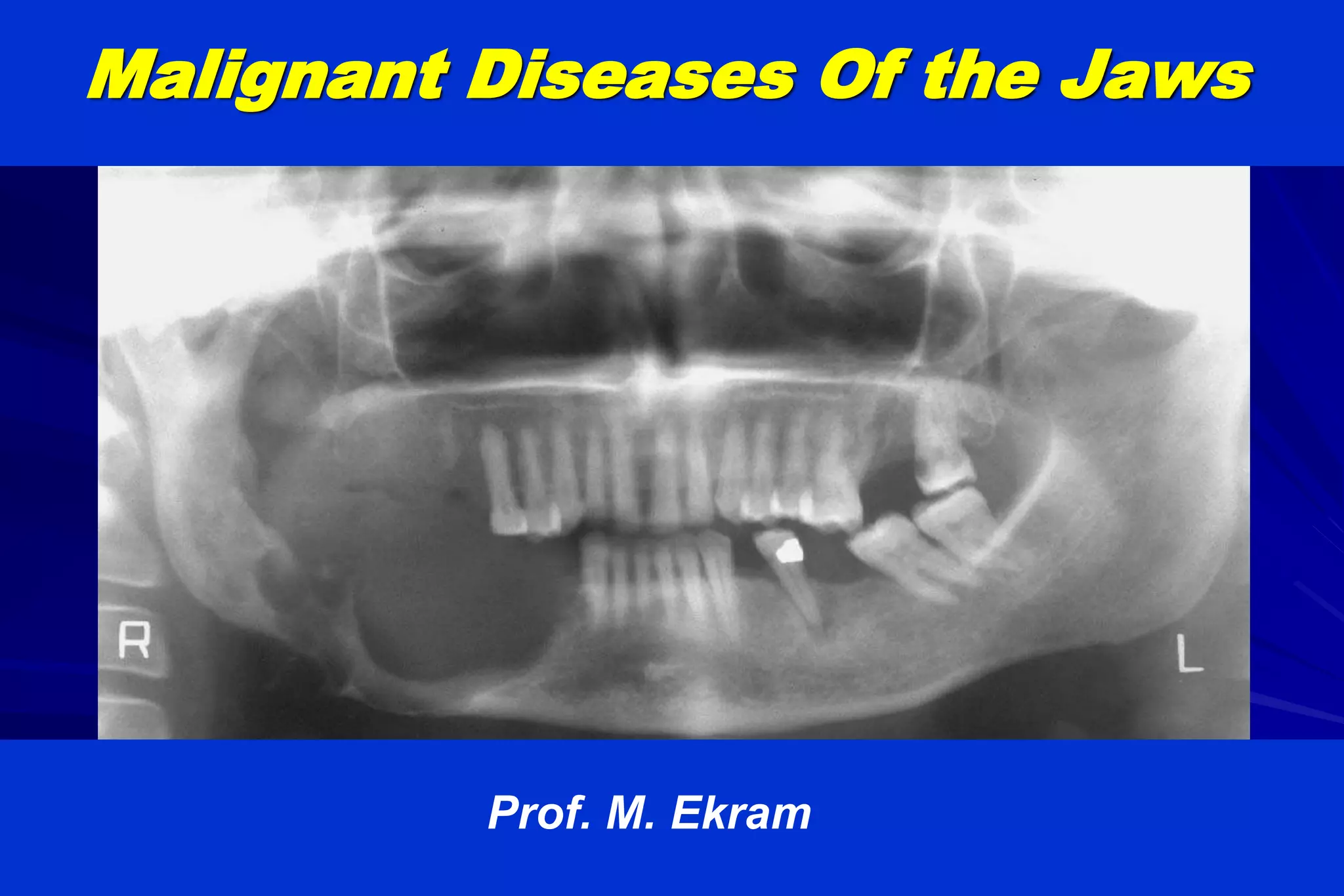 Radiographic assessment of malignant disease of the ortal cavity & jaws ...