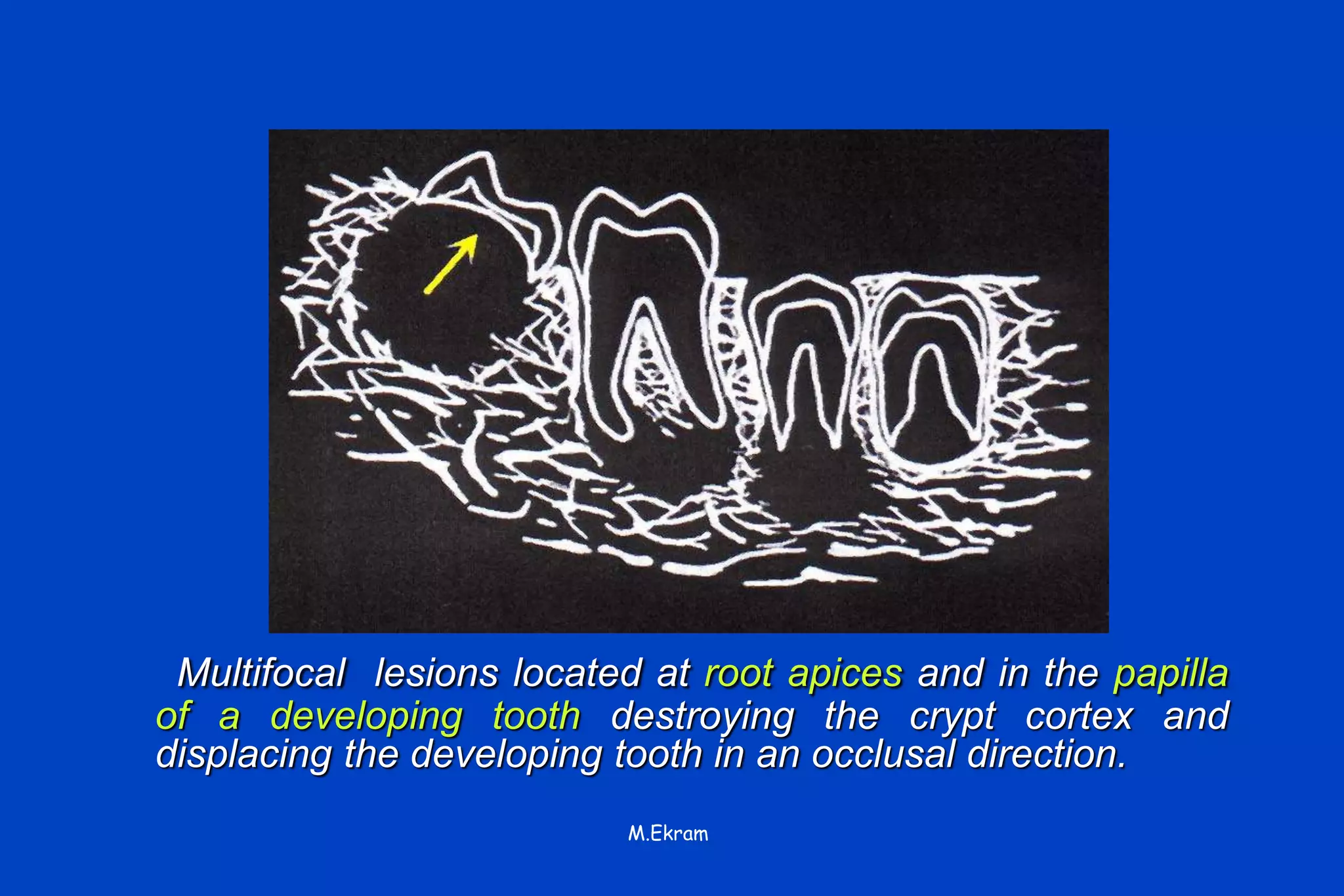 Radiographic assessment of malignant disease of the ortal cavity & jaws ...