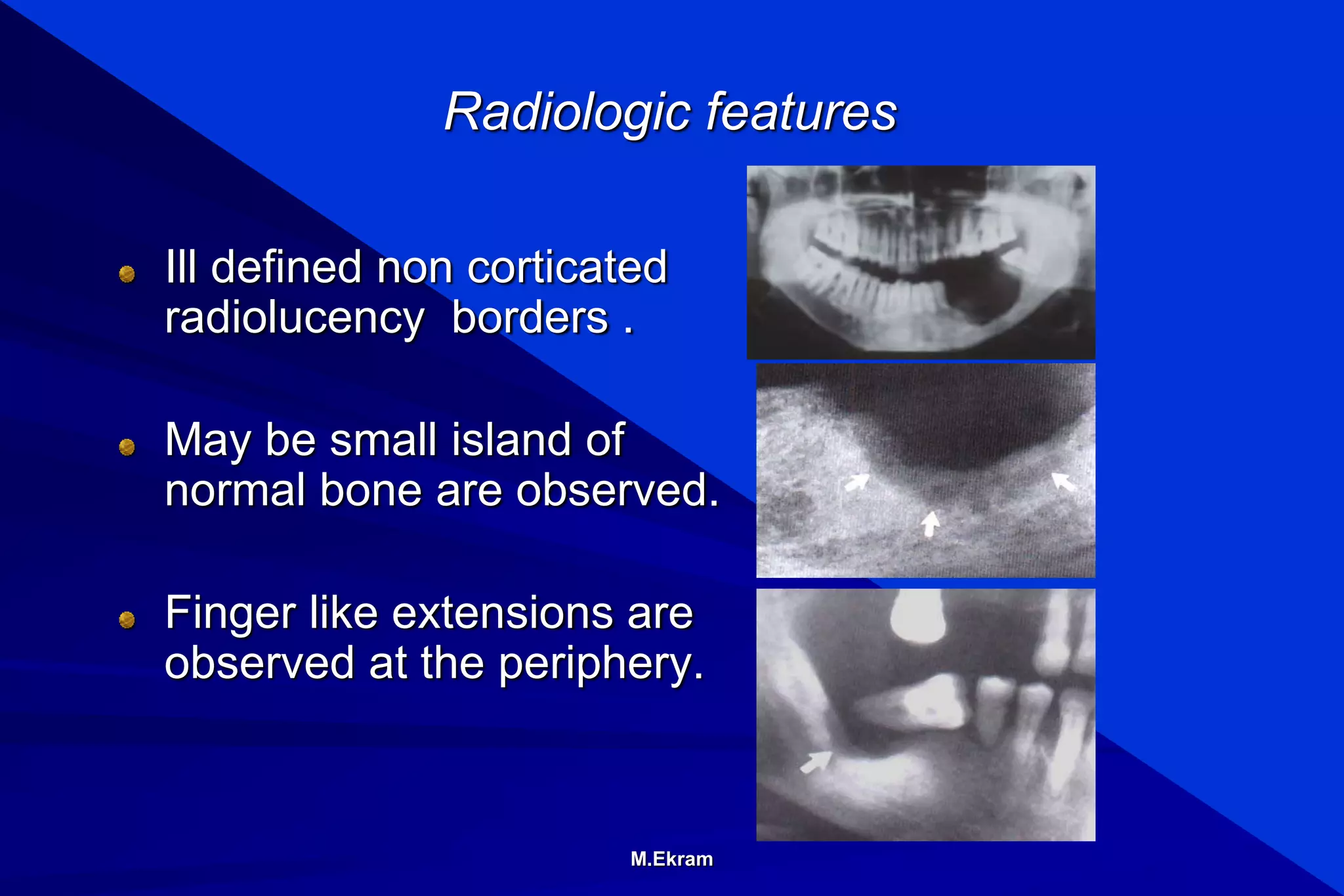 Radiographic assessment of malignant disease of the ortal cavity & jaws ...