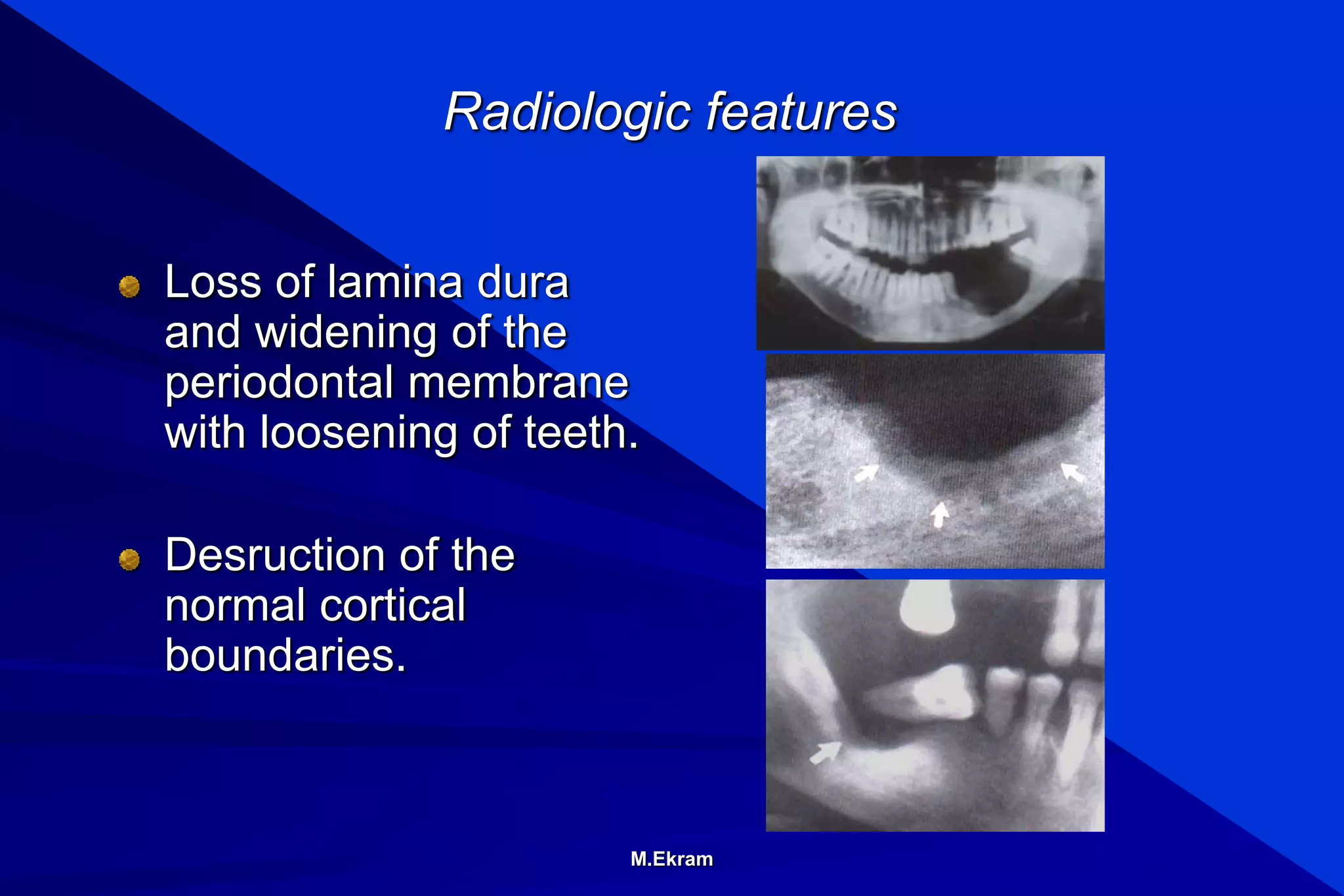 Radiographic assessment of malignant disease of the ortal cavity & jaws ...