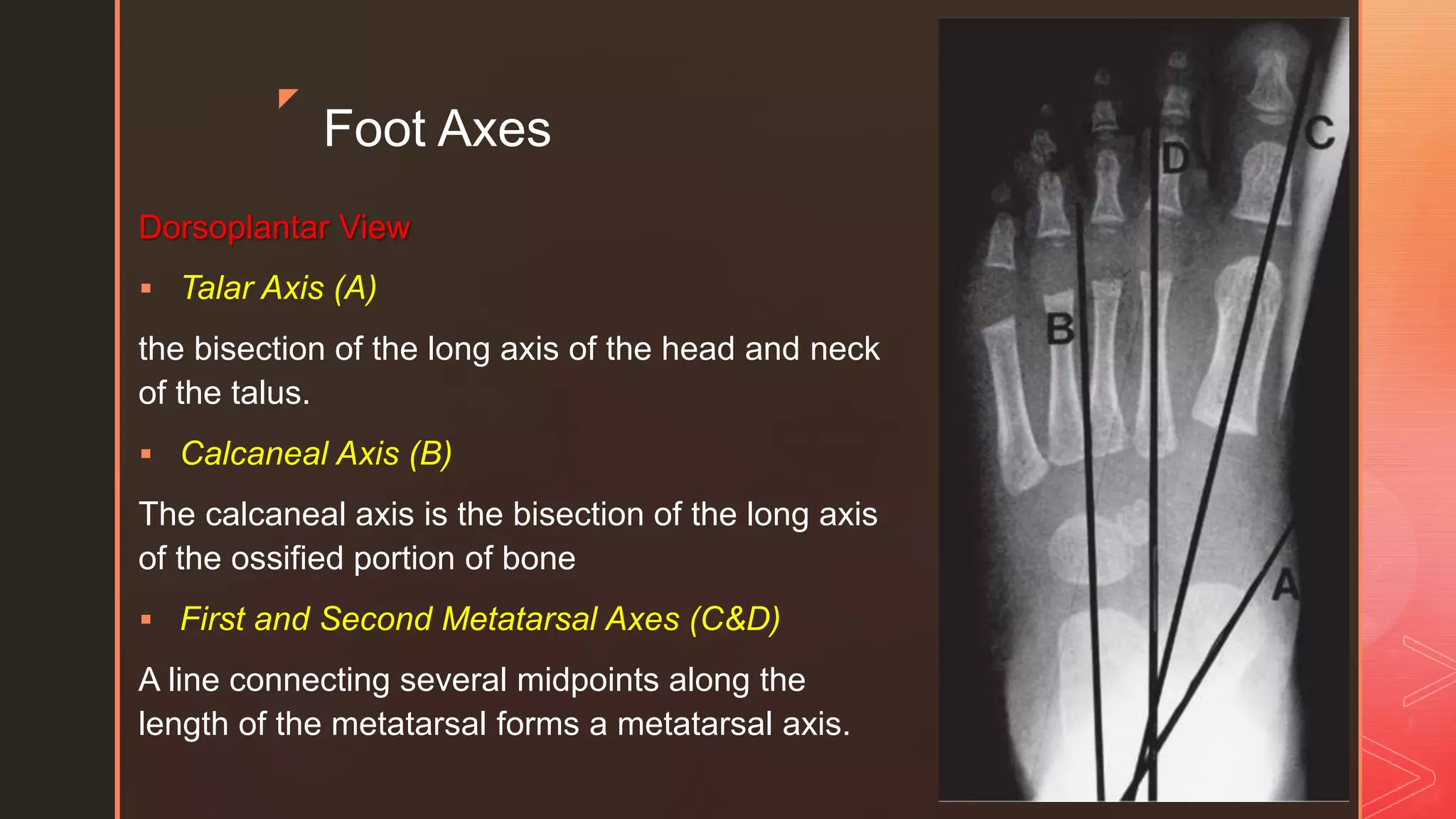 Radiographic assessment of pediatric foot alignment | PPTX