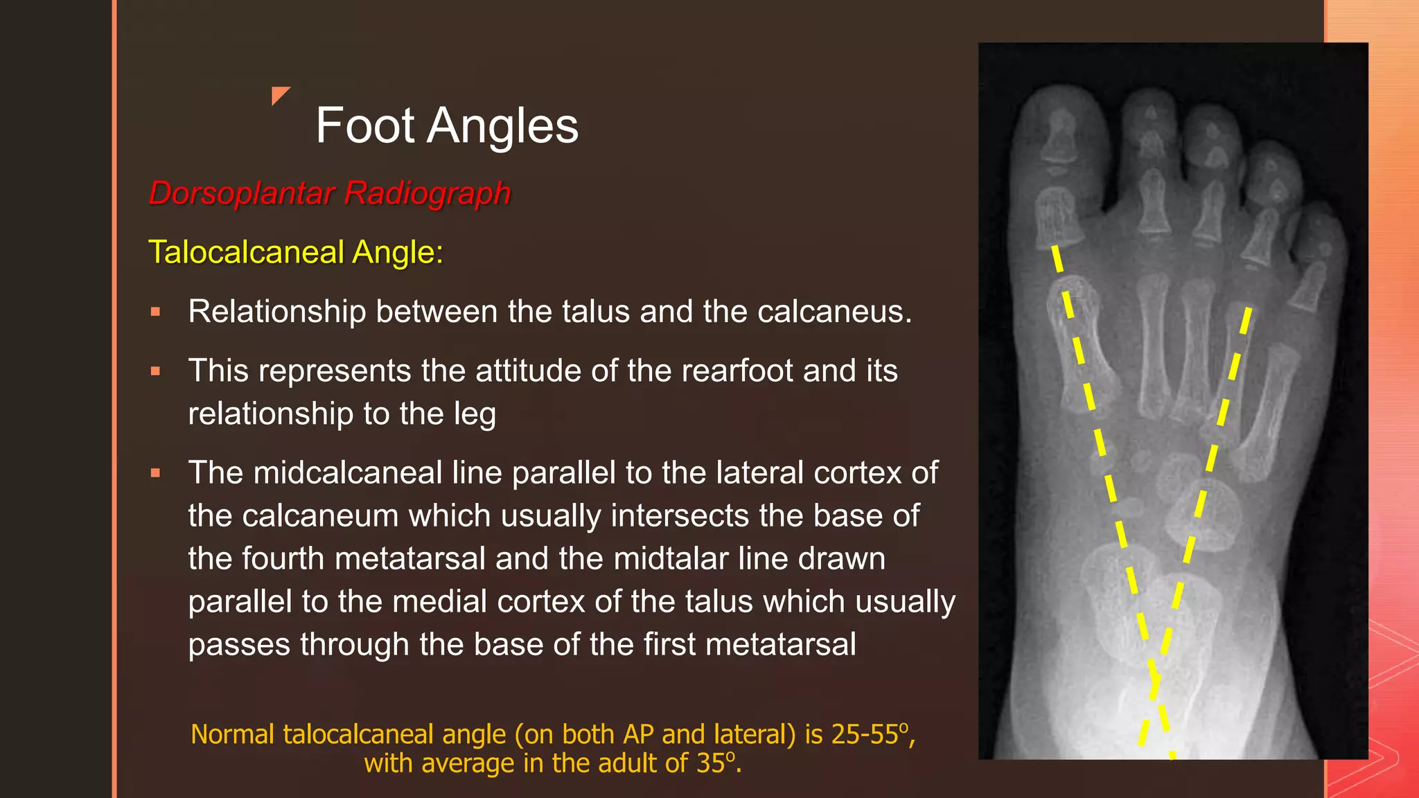 Radiographic assessment of pediatric foot alignment | PPTX