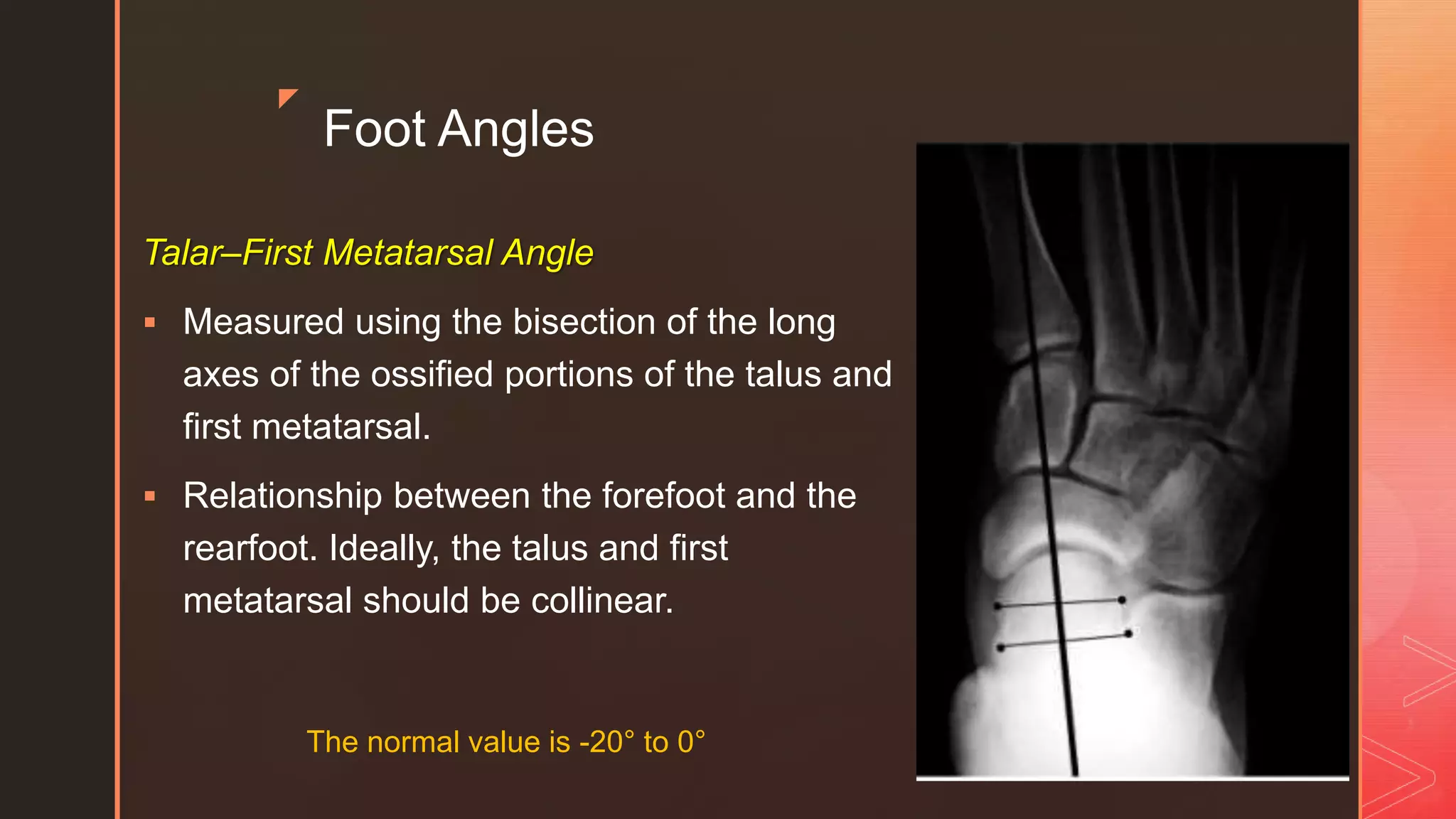 Radiographic assessment of pediatric foot alignment | PPTX