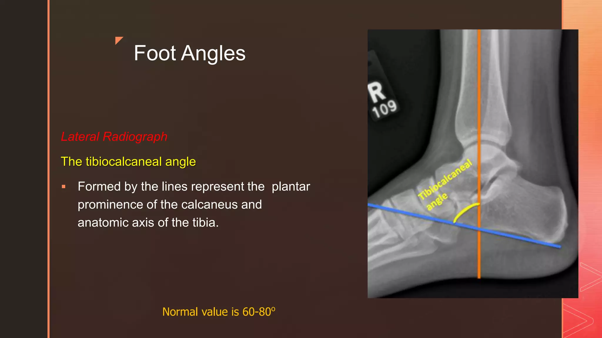 Radiographic assessment of pediatric foot alignment | PPTX