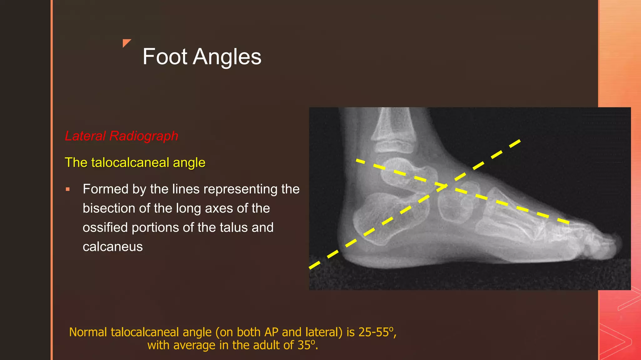 Radiographic assessment of pediatric foot alignment | PPTX