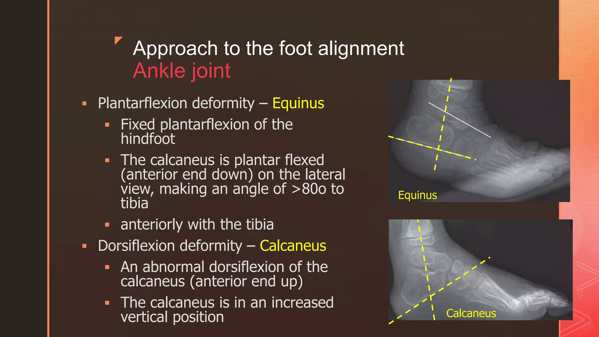 Radiographic assessment of pediatric foot alignment | PPTX