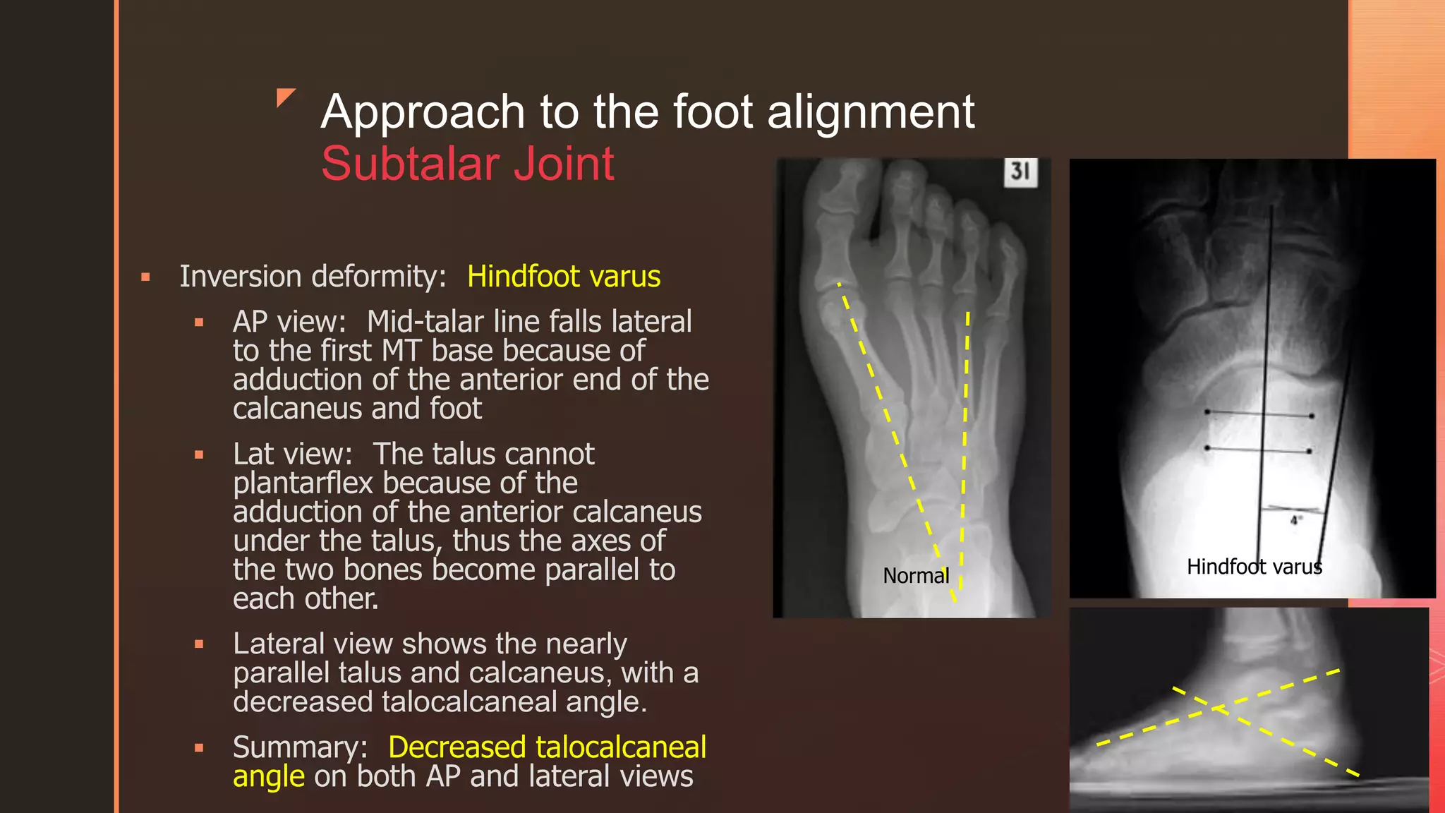 Radiographic assessment of pediatric foot alignment | PPTX