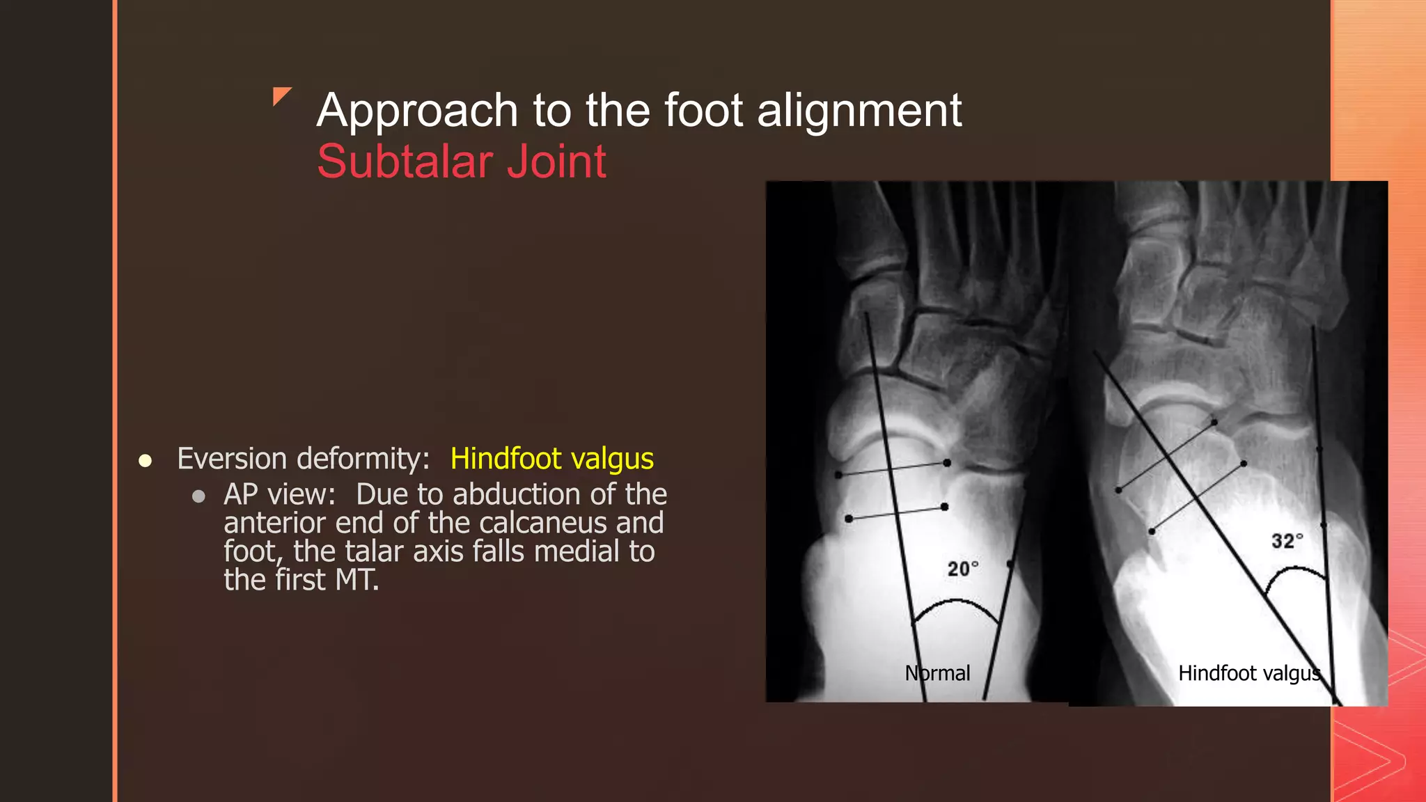 Radiographic assessment of pediatric foot alignment | PPTX