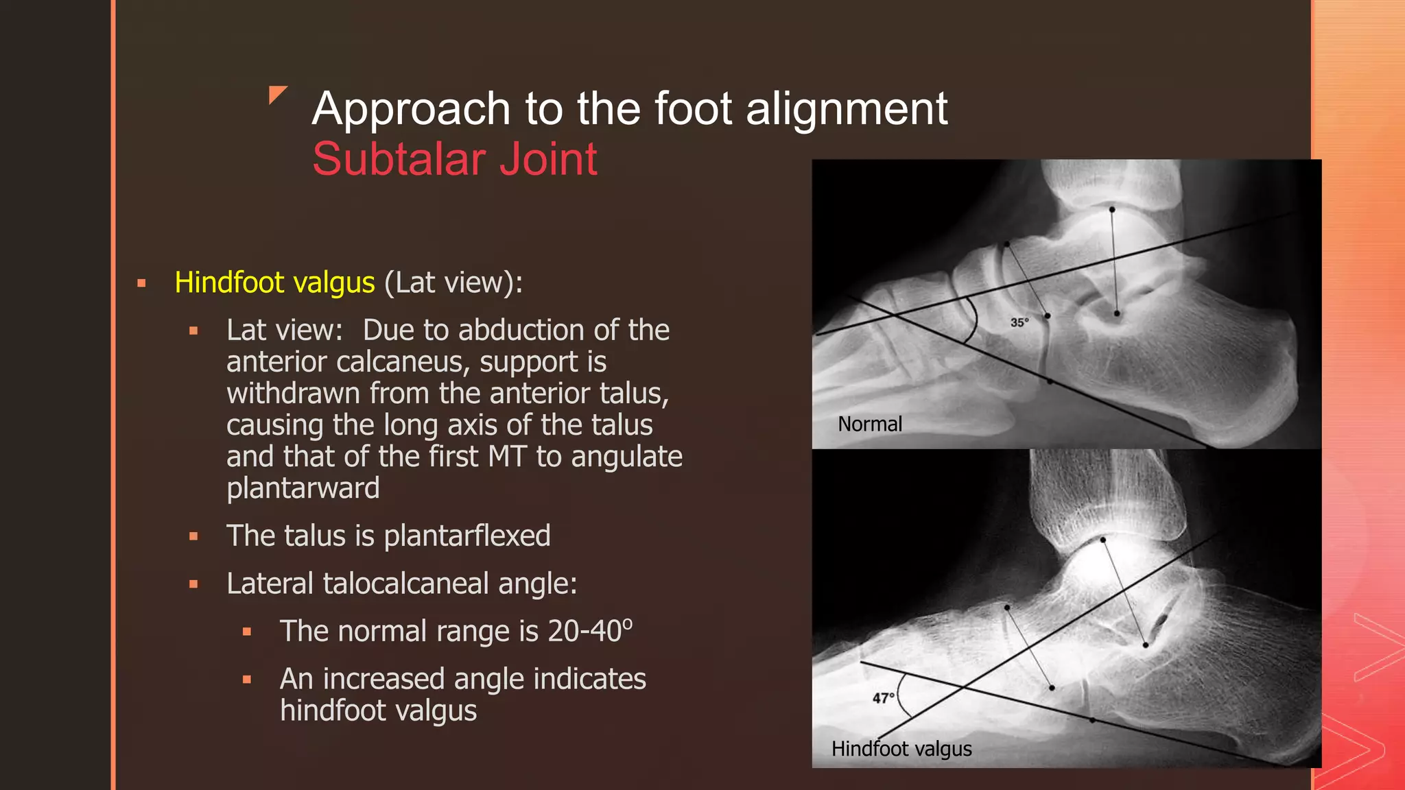 Radiographic assessment of pediatric foot alignment | PPTX
