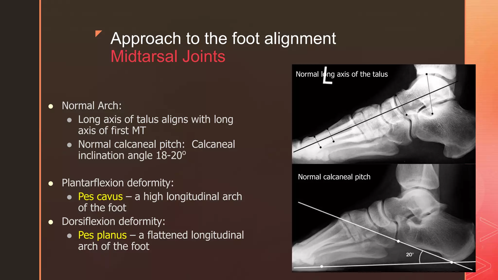 Radiographic assessment of pediatric foot alignment | PPTX