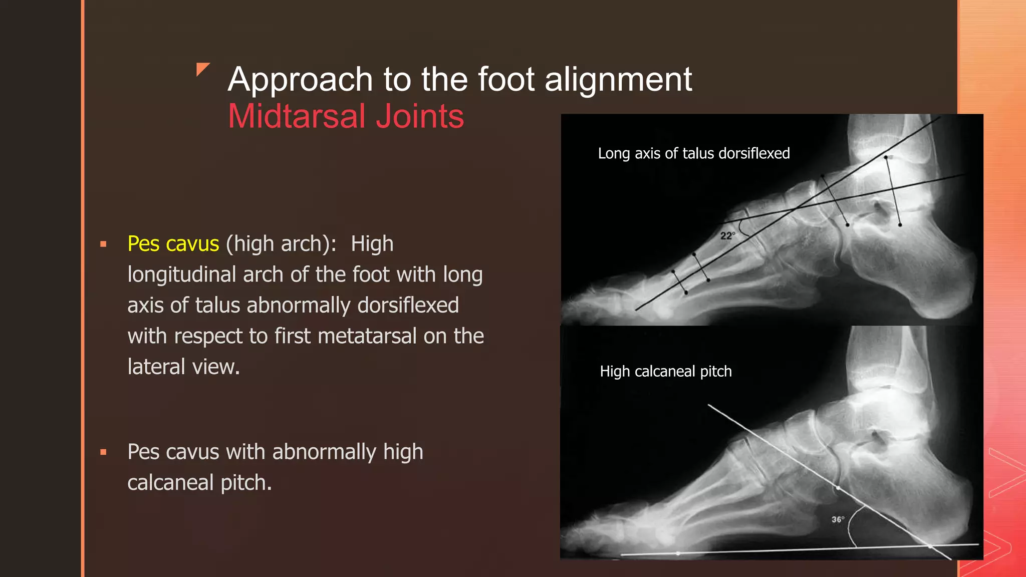 Radiographic assessment of pediatric foot alignment | PPTX