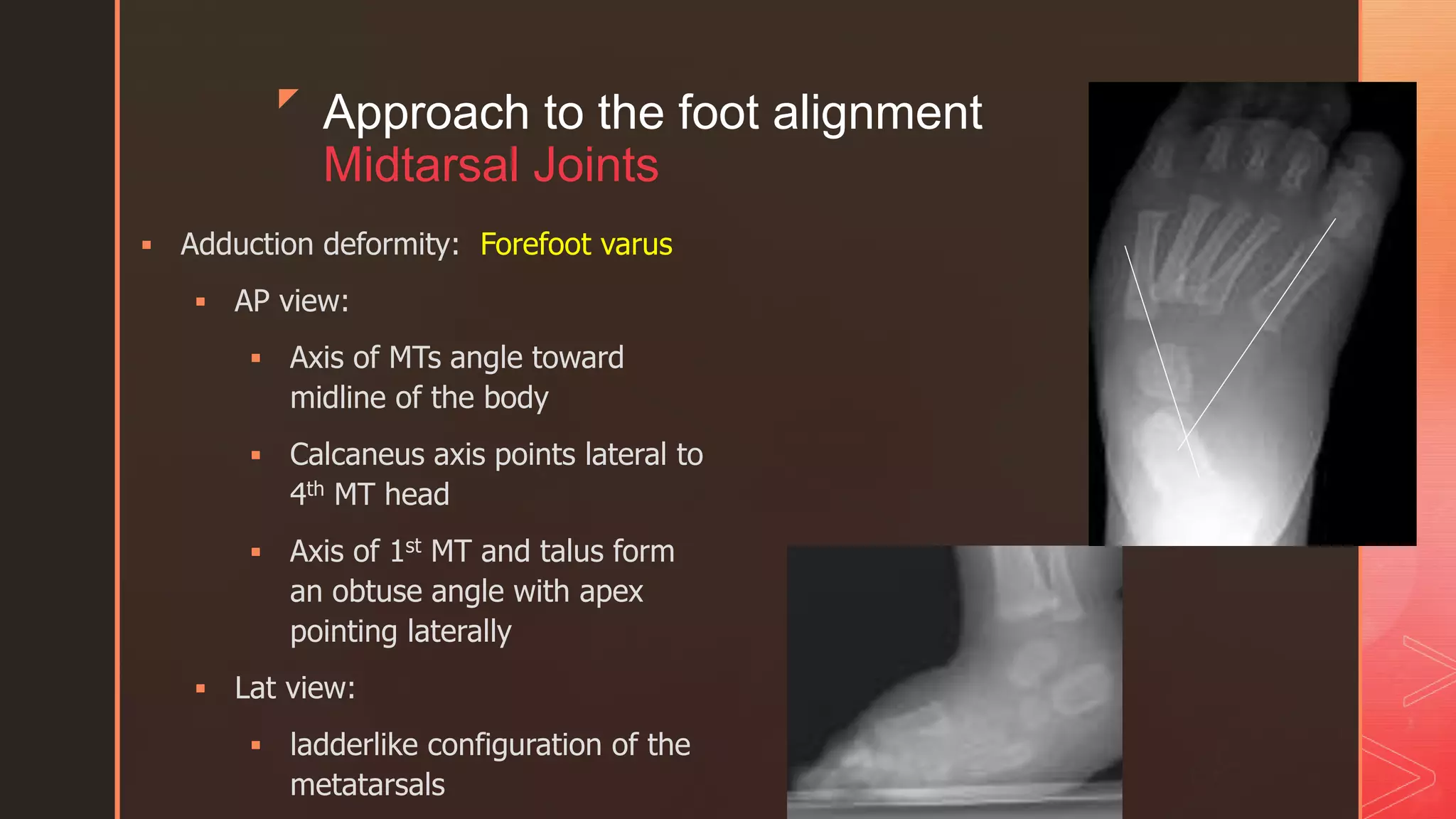 Radiographic assessment of pediatric foot alignment | PPTX