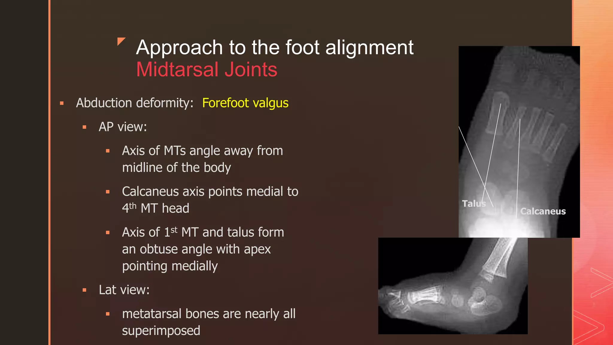 Radiographic assessment of pediatric foot alignment | PPTX