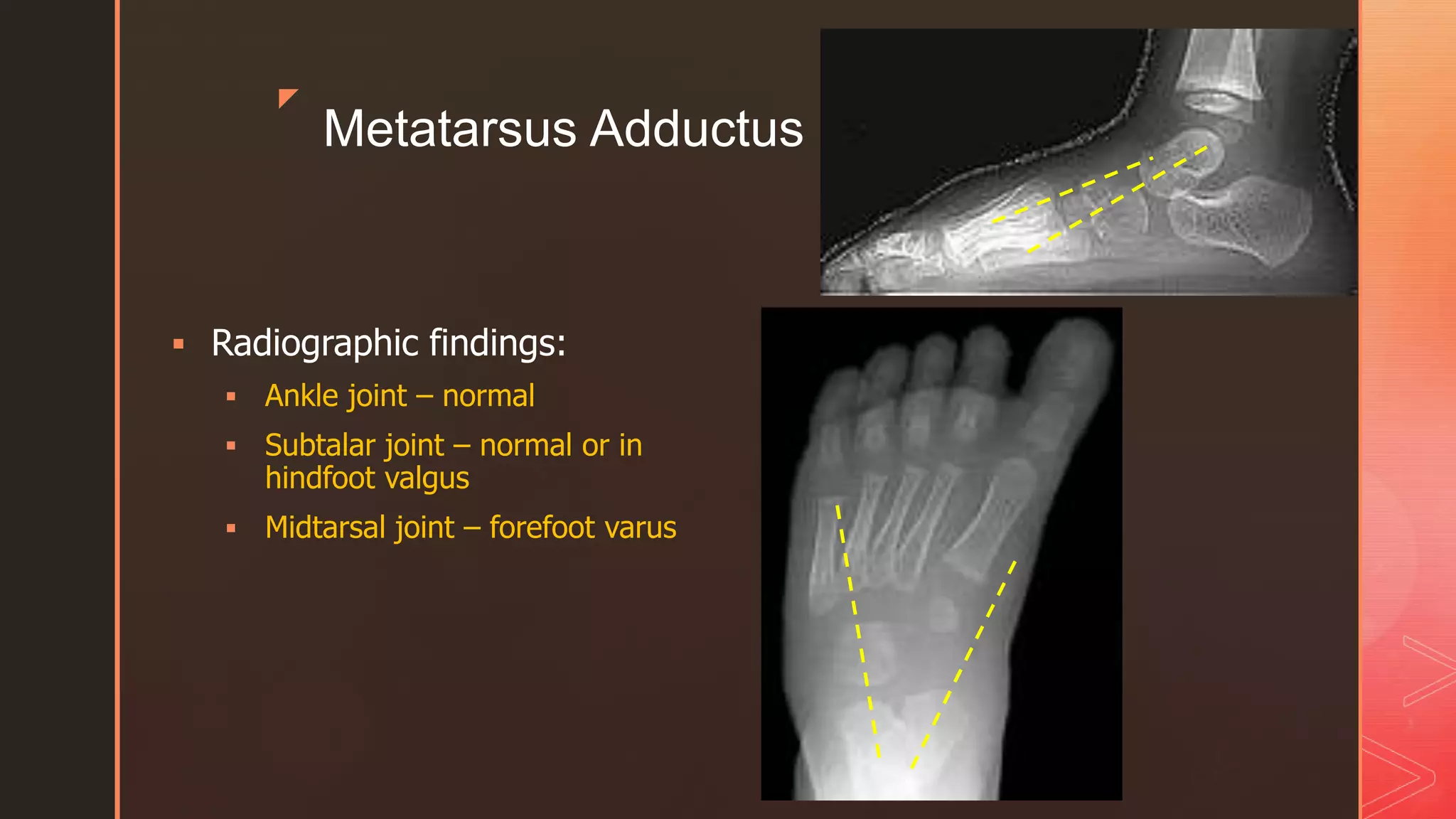 Radiographic assessment of pediatric foot alignment | PPTX