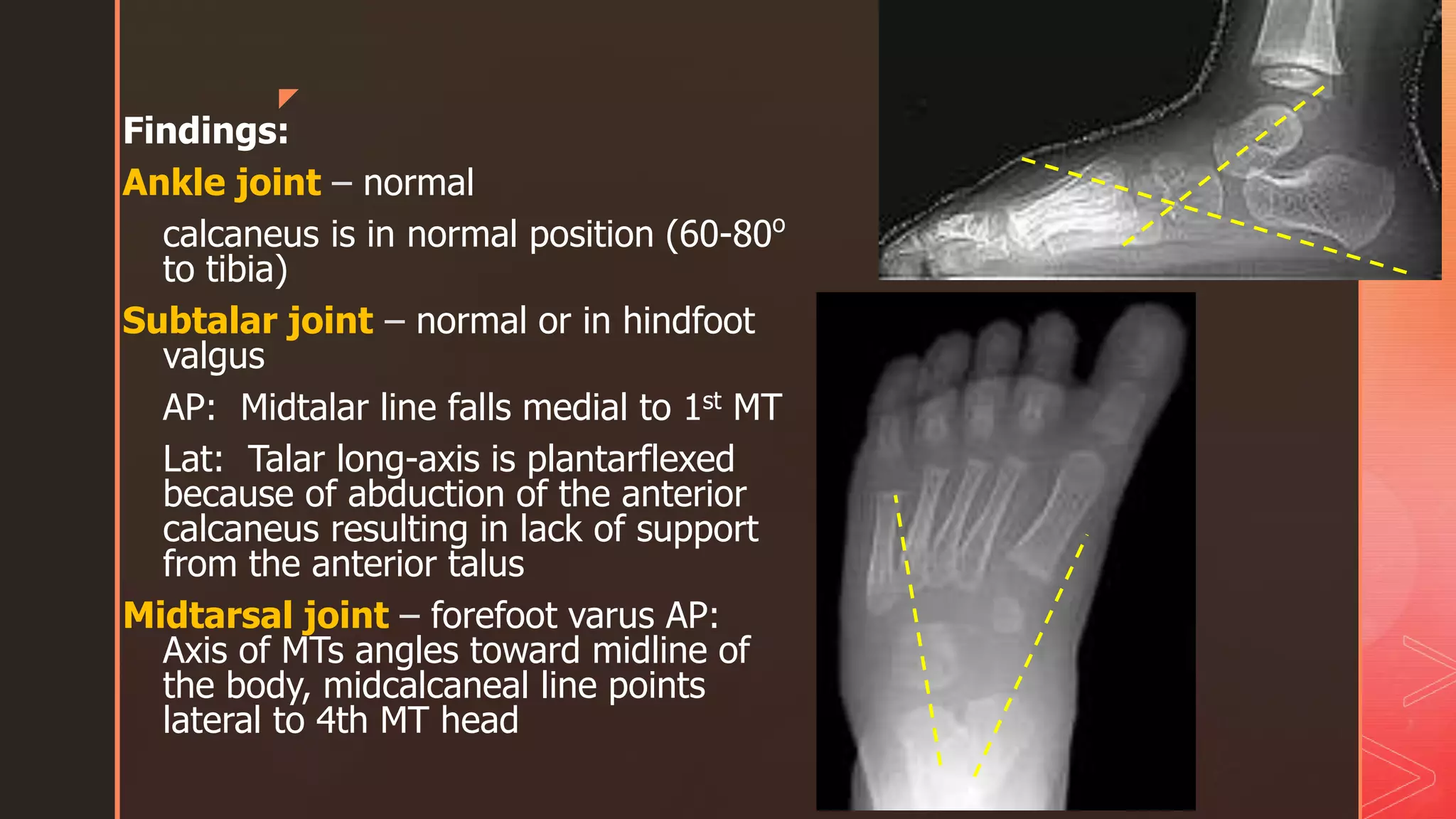 Radiographic assessment of pediatric foot alignment | PPTX