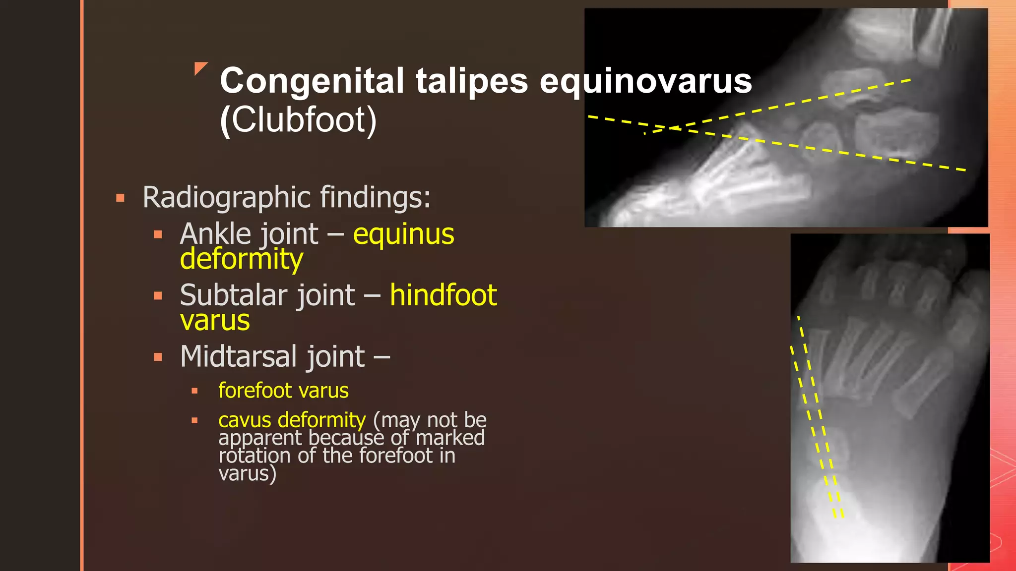 Radiographic assessment of pediatric foot alignment | PPTX