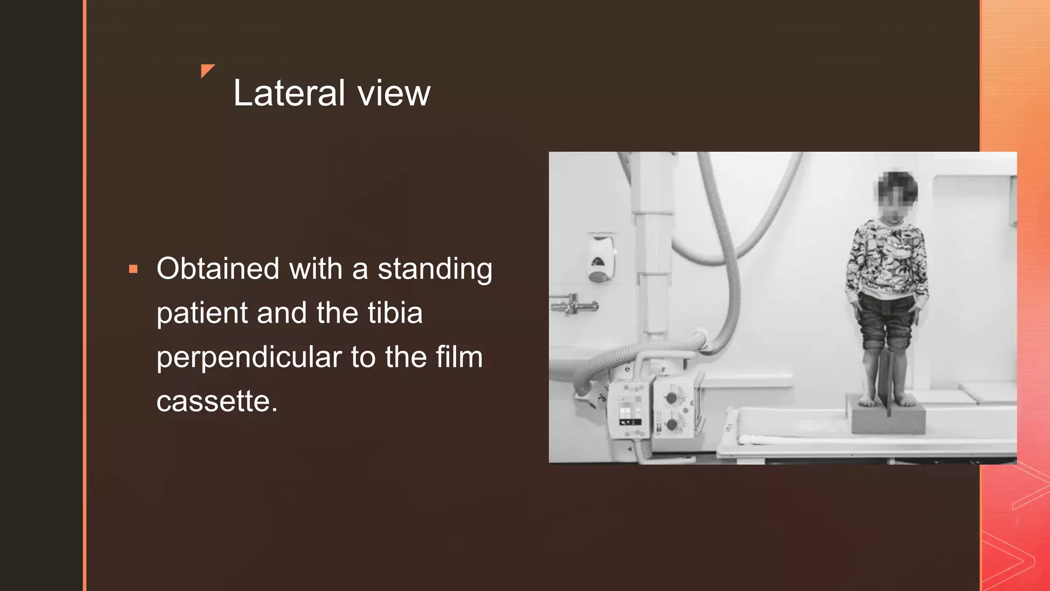 Radiographic assessment of pediatric foot alignment | PPTX
