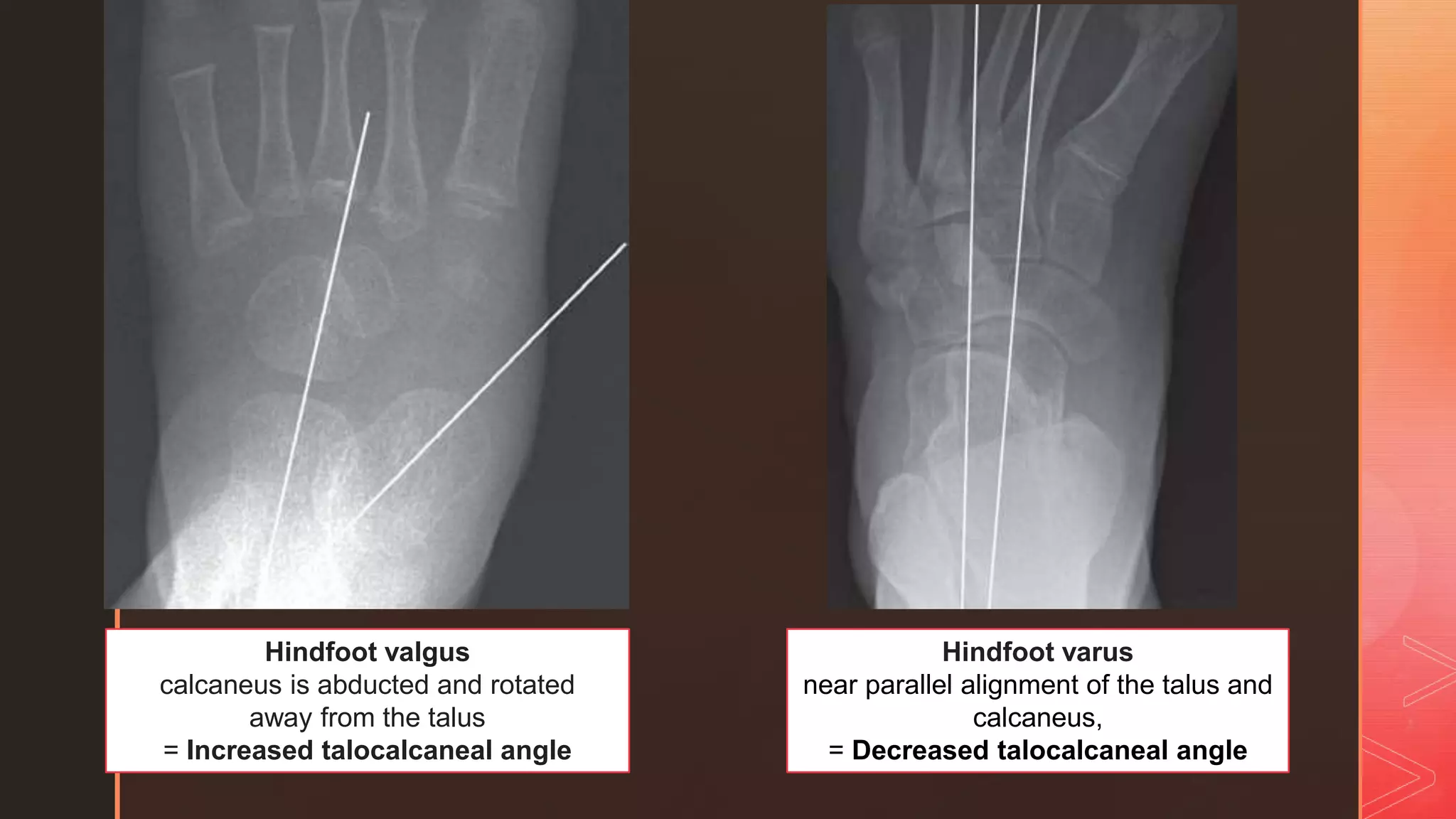 Radiographic assessment of pediatric foot alignment | PPTX