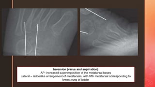 Radiographic assessment of pediatric foot alignment | PPTX