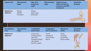 Radiographic assessment of pediatric foot alignment | PPTX