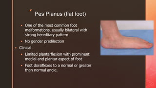 Radiographic assessment of pediatric foot alignment | PPTX