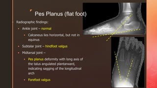 Radiographic assessment of pediatric foot alignment | PPTX
