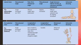Radiographic assessment of pediatric foot alignment | PPTX