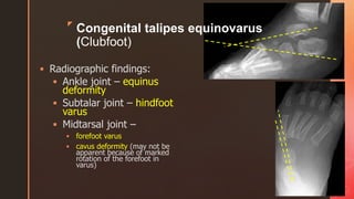 Radiographic assessment of pediatric foot alignment | PPTX