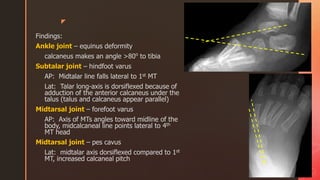 Radiographic assessment of pediatric foot alignment | PPTX