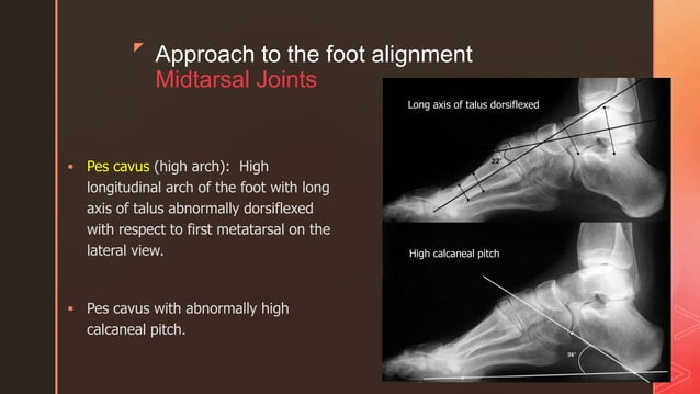 Radiographic assessment of pediatric foot alignment