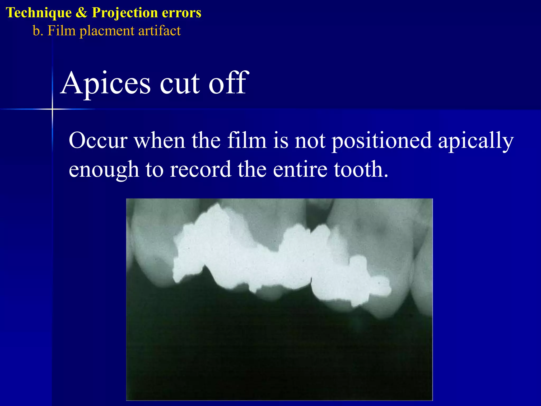 Radiographic errors and artifacts | PPTX